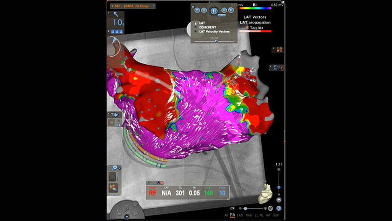 3D-Mapping: Europapremiere von neuer Therapie - MT-Dialog