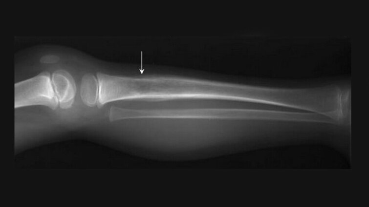 Knochenkrebs - Neue therapeutische Möglichkeiten? - MT-Dialog