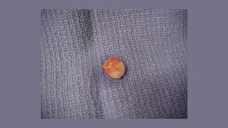 Haar-Zyste liefert Erkenntnisse zur Tumorentstehung - MT-Dialog