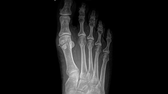 Radiologische Diagnostik: Varianz der Sesambeine des Vorfußes - MT-Dialog