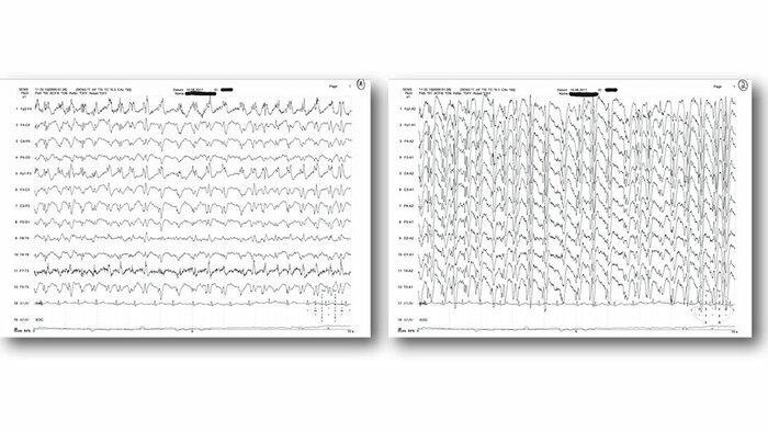 Status epilepticus (klinisch fokal) - MT-Dialog
