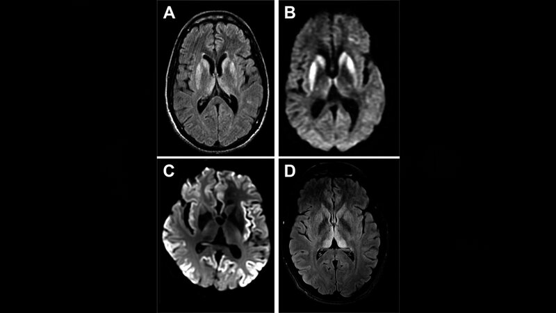 Creutzfeldt-Jakob: Überlebenszeit vorhersagbar? - MT-Dialog