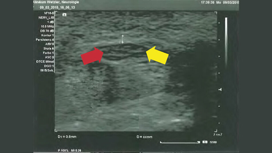 Sonographie des Nervus medianus und des Nervus ulnaris - MT-Dialog