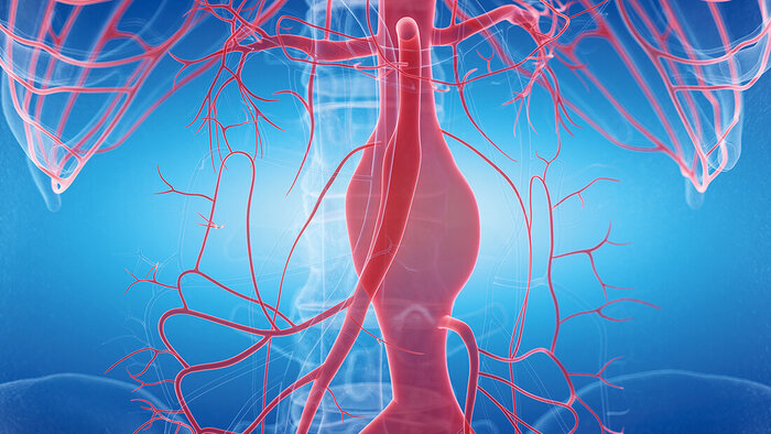 Erkrankungen der Aorta - MT-Dialog
