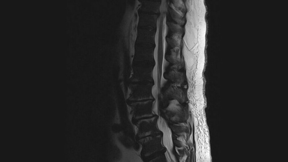 Chronisch-myeloische Leukämie und Myelofibrose - MT-Dialog