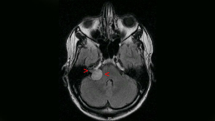 Nimodipin bei Behandlung des Akustikusneurinoms - MT-Dialog