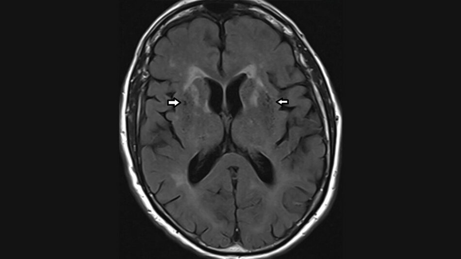 Anomalien und Normvarianten – Zerebrale Diagnostik 1.8: Varianz der Virchow-Robin-Räume - MT-Dialog