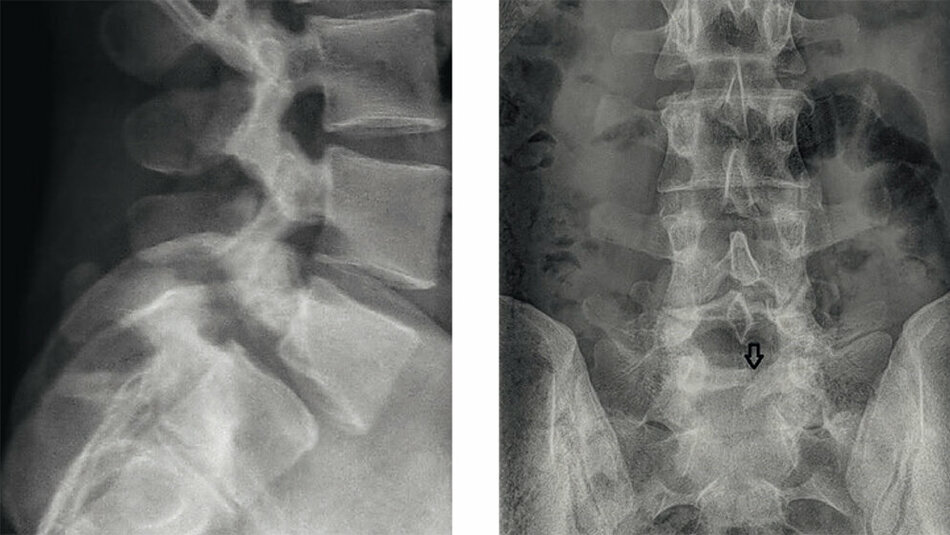 Anomalien und Normvarianten - Skelettale Veränderungen 3.8 ...