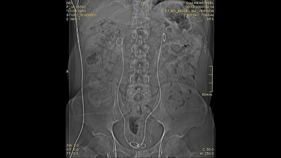 Tumoröse Veränderungen: Morbus Ormond - MT-Dialog