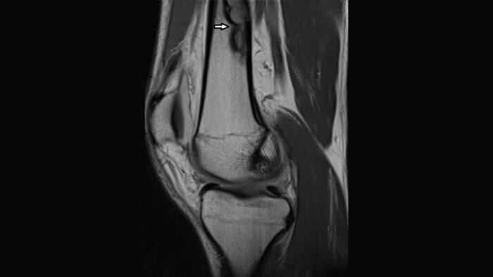 Anomalien und Normvarianten – Nicht ossifizierendes Fibrom - MT-Dialog