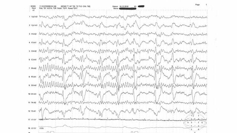 Periodisch lateralisierte Komplexe (PLEDs) im EEG - MT-Dialog