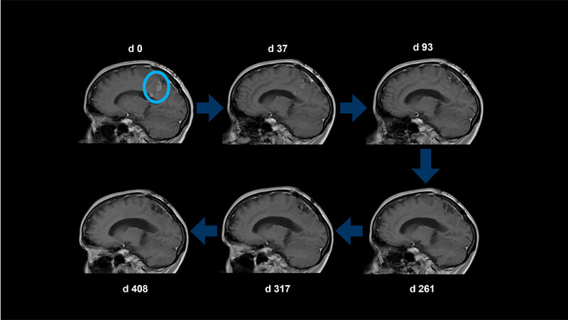 Glioblastome am Wachsen hindern - MT-Dialog
