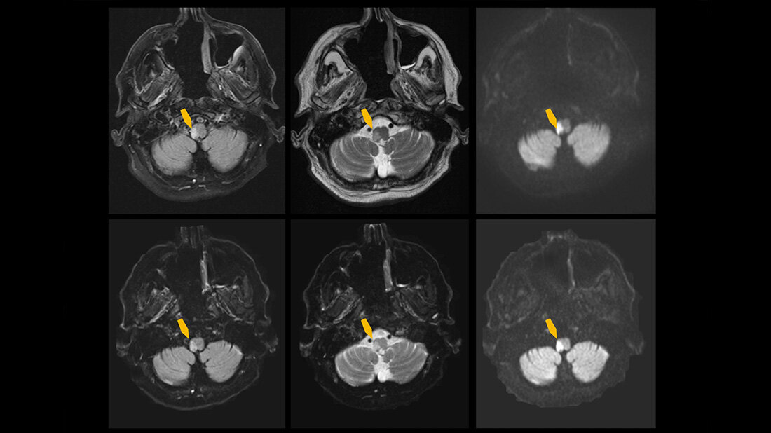 MRT-Technik: Schlaganfälle schnell erkennen - MT-Dialog