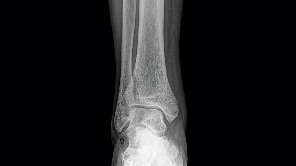 Anomalien und Normvarianten – Skelettale Veränderungen 3.21 - MT-Dialog
